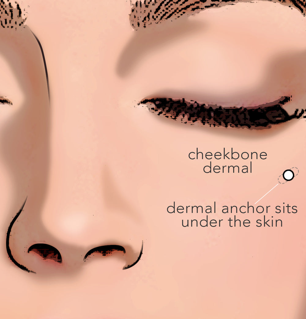 Dermals v. Surface Bars